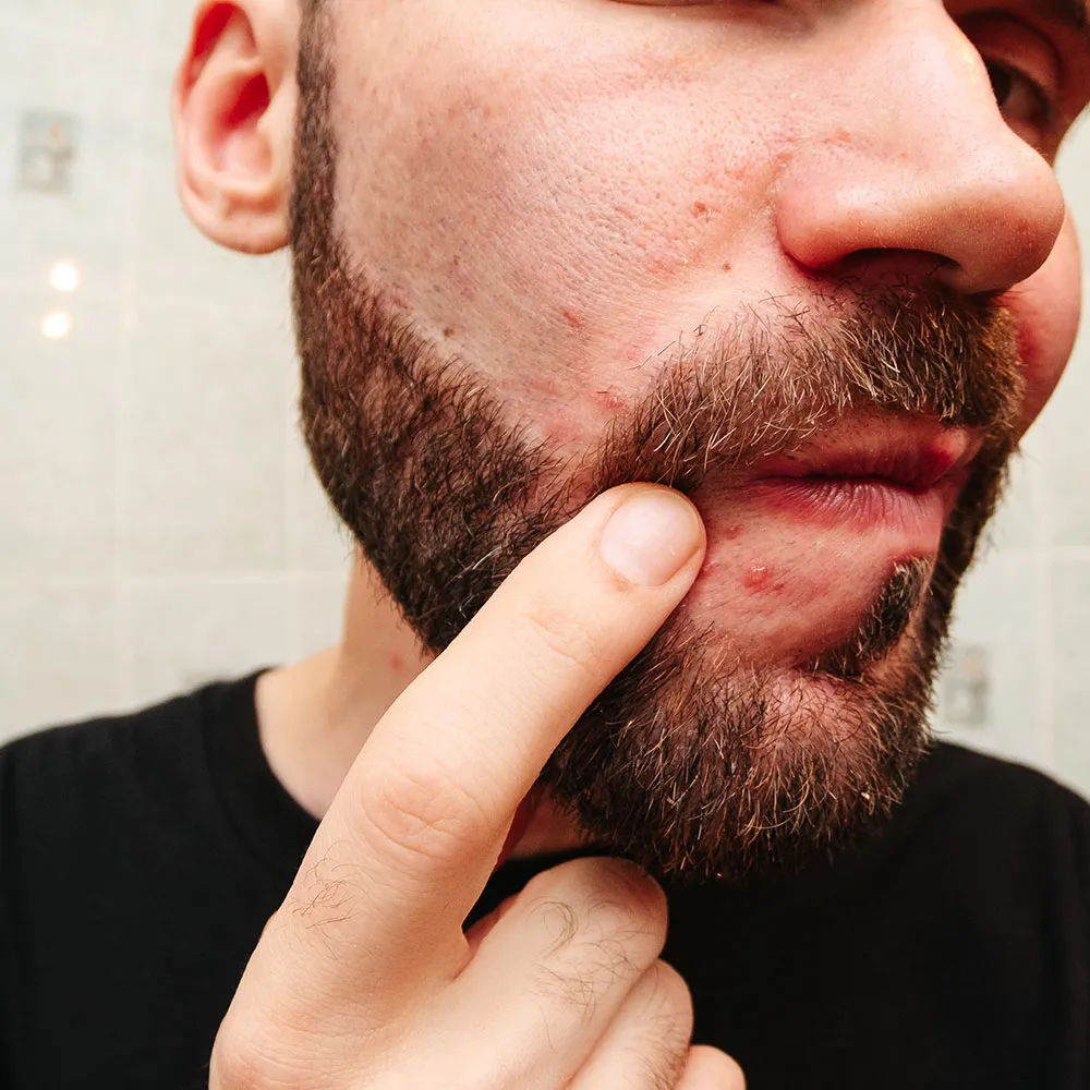 Should You Try and Pop a Cold Sore? What to Do Instead | Ro