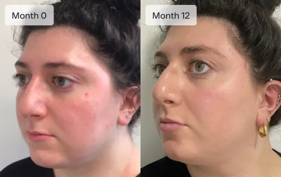 Custom Prescription Skincare Dermatology RX Treatment | Ro